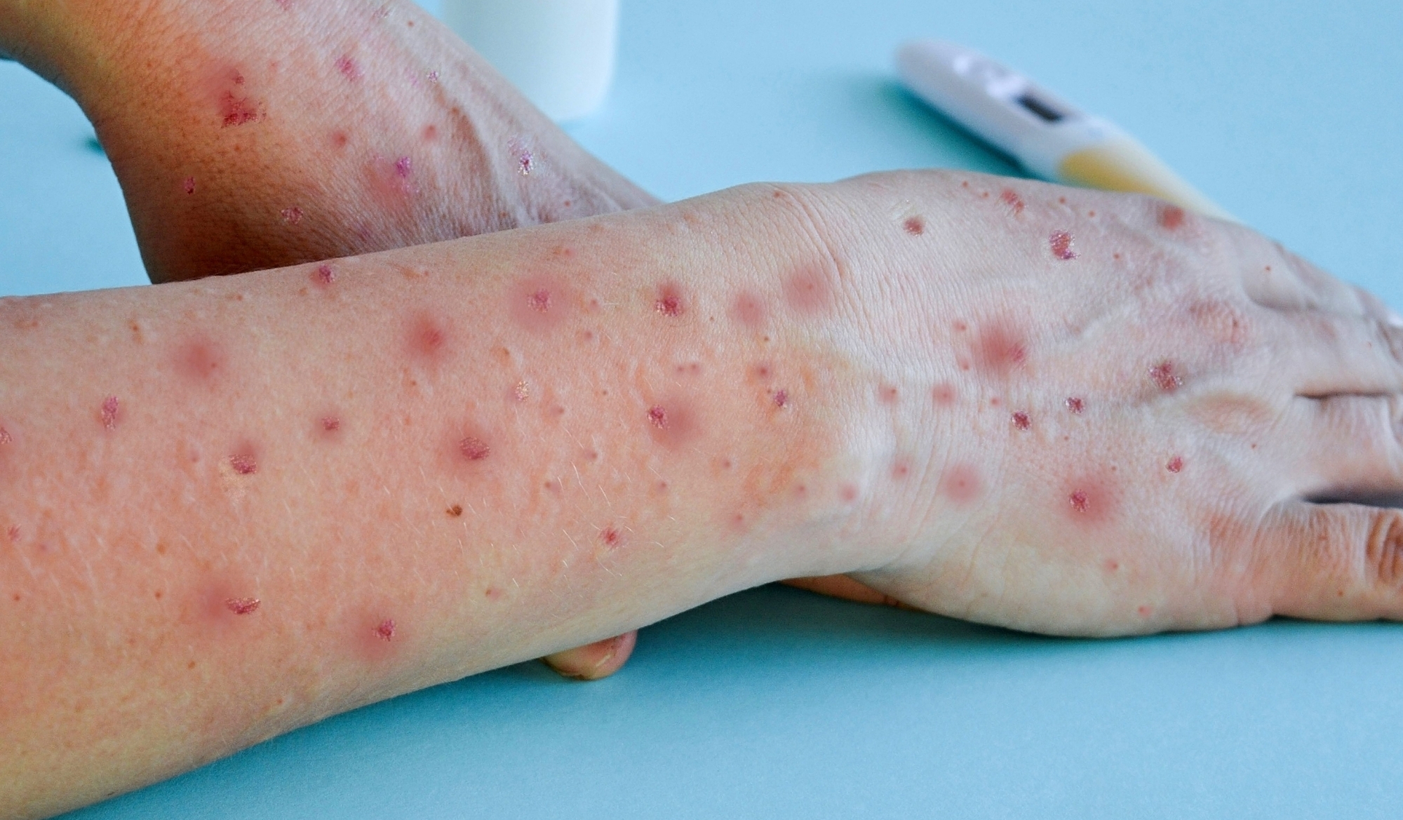 Affenpocken (Mpox): Was die WHO-Notlagendebatte für Baden-Württemberg ...